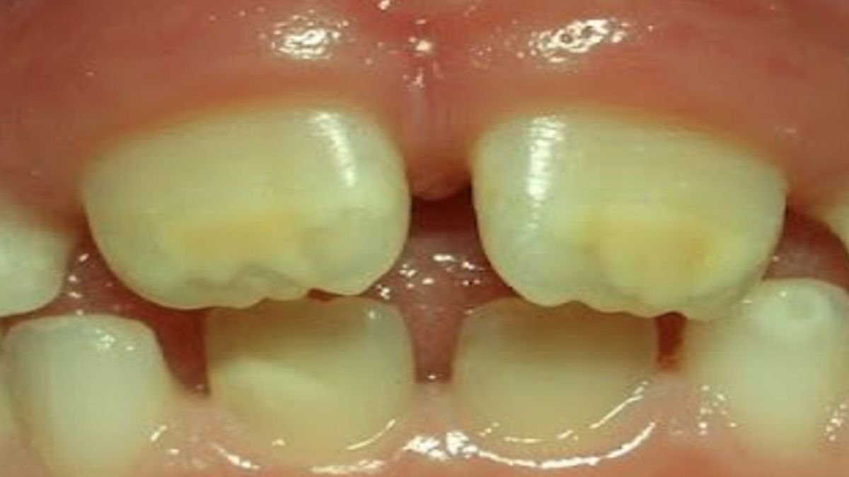 esmalte dental Archives - Zonadental